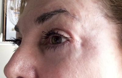 What's the best treatment for dents on the side of my eyes after lower ...