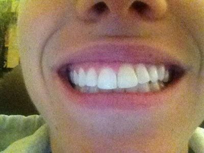 Can Veneers fix my slanted smile and asymmetrical gumline? (photos ...