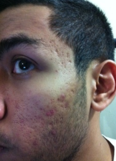 TCA Cross on Temple Acne scars? (Photo) Doctor Answers, Tips