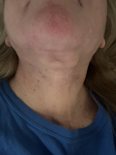 5 weeks post-op & concerned about this area under my chin