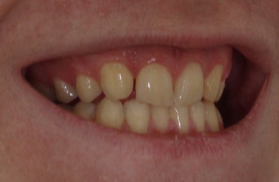 Can my teeth be moved backwards/sideways to make spaces for lateral ...