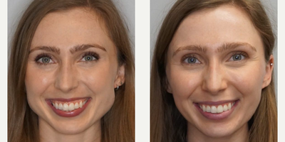 Botox Before & After Pictures - RealSelf