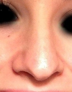 Right nasal bone sticking out, left side of my nose collapsing, crooked ...