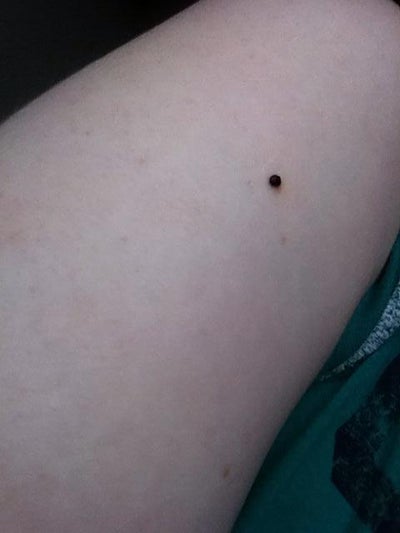 A mole on my arm got bigger but then smaller again. It's slighty red ...