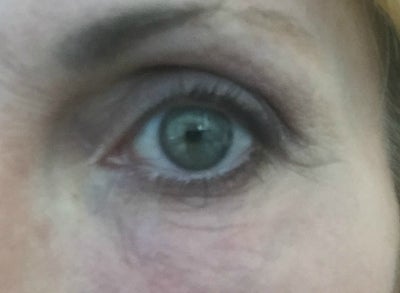 I damaged my under eye skin with Hyaluronidase. What can I do to regain ...