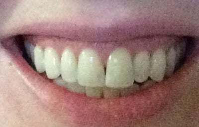 Would filing bottom sides of two front teeth help reduce the gap in ...