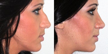 Can a frontal sinus infection cause forehead swelling? (Photo) Doctor ...