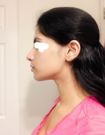 Want V (tear/tapered shaped) defined jaw + chin projection. Sliding ...