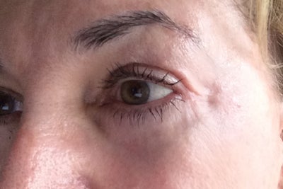What's the best treatment for dents on the side of my eyes after lower ...