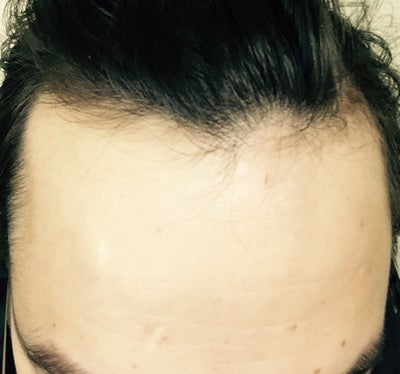 High forehead with recessed corners, looking for more feminine shape ...