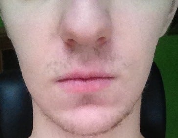 Been bothered by my deep labiomental fold and aesthetics of my facial ...