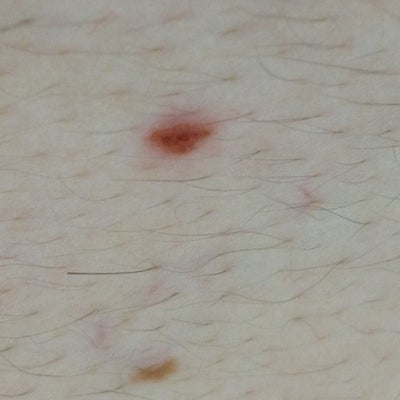 Inflamed Mole Biopsy. Is it Common to Send Back to Pathologist to ...