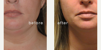 Venus Legacy Before & After Pictures - RealSelf