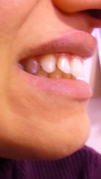 Can braces (without tooth extraction) solve upper lip protrusion ...