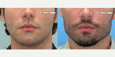 Dermal Fillers Before & After Pictures - RealSelf