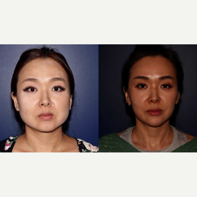 Botox for TMJ Before & After Pictures - RealSelf