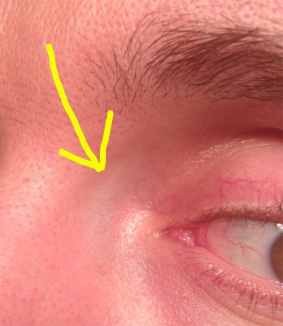 What can be done about dark spots on nose bridge/root (next to eyes ...