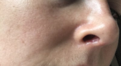 Inner nostril redness and broken capillaries visible - rhinoplasty ...