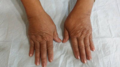 I had collagen injection on my hands in 2006 to remove wrinkles & my ...