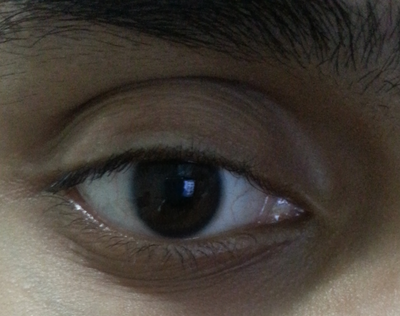 How could I get rid of my bulgy eyes? (Photo) Doctor Answers, Tips