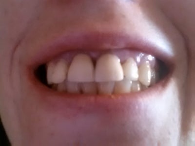 Should I replace the top four front teeth with a dental plate? (photo ...