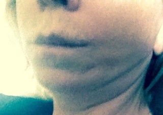7 months after facelift, will micro needling help my rippling and ...