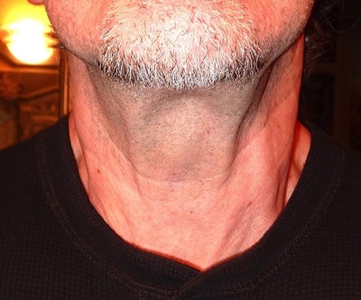 Is There a Procedure to Remove Loose Neck Bands? (photo) Doctor Answers ...