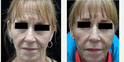 Collagen Injection Before & After Pictures - RealSelf