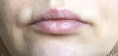 Will blood flow restart if I have had vascular occlusion near the upper ...