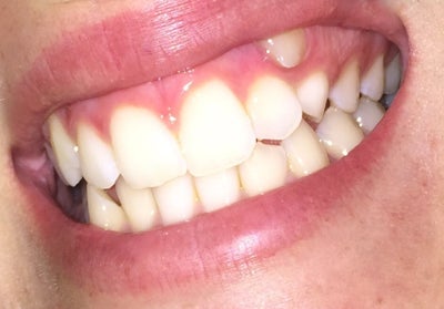 Is it possible to fix my snaggle tooth with Invisalign? Or for it to be ...