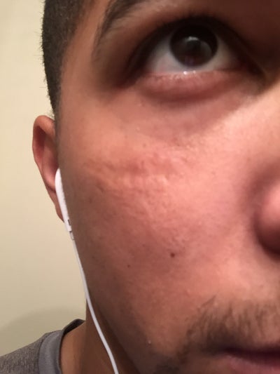 Railroad track scars on face (Photo) Doctor Answers, Tips