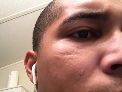 Railroad track scars on face (Photo) Doctor Answers, Tips