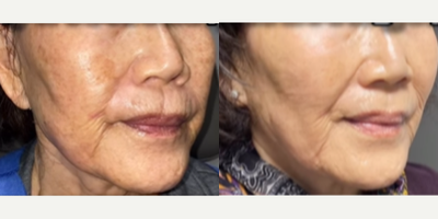 NeoGen Plasma Before & After Pictures - RealSelf