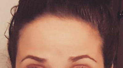 Which procedure is best for me to correct a widow's peak and uneven ...