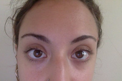 Heavy eyebrow feeling - should I get Botox? (Photo) Doctor Answers, Tips