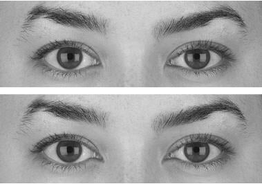 Is it possible to define/extend/re-angle the inner canthus? (Photo ...