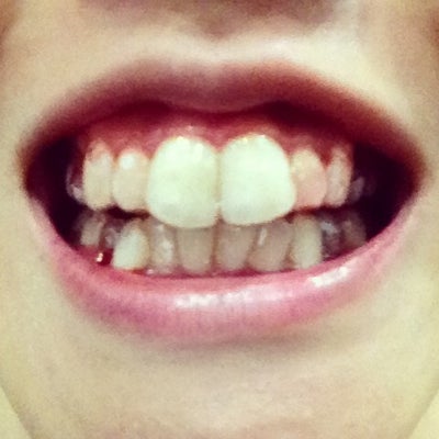 Invisalign Treatment for Big Buck Teeth - Invisalign review - RealSelf