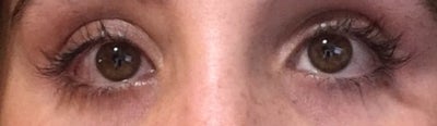 How can I fix the appearance of crossed eyes (pseudostrabismus)? Please ...