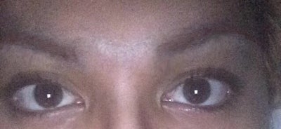 What can be done to lift outer corners of eyes? Doctor Answers, Tips