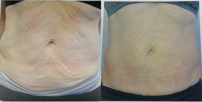 Profound RF Before & After Pictures - RealSelf