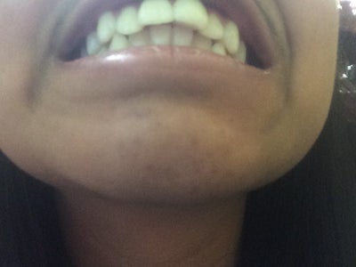 Is it alright if one of my bottom tooth is touching my crown tooth ...