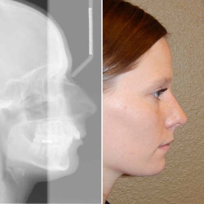 Deep labiomental fold and curved chin after sliding genioplasty. Will ...