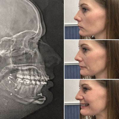 Deep labiomental fold and curved chin after sliding genioplasty. Will ...