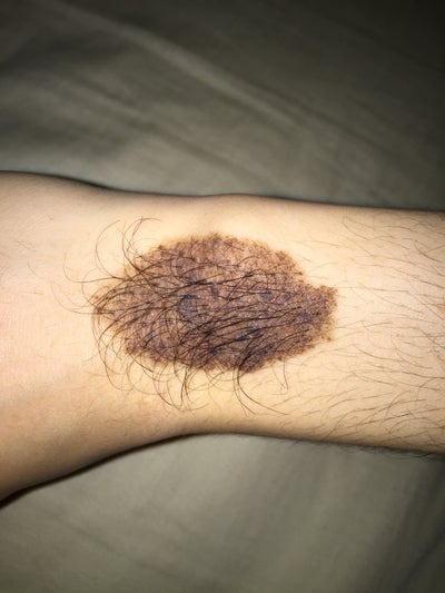 Congenital Nevus Removal