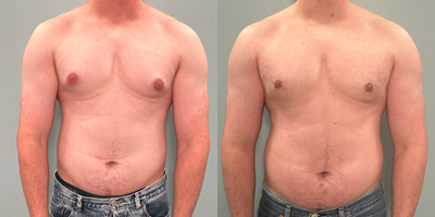 Gynecomastia Surgery Before After Pictures Realself