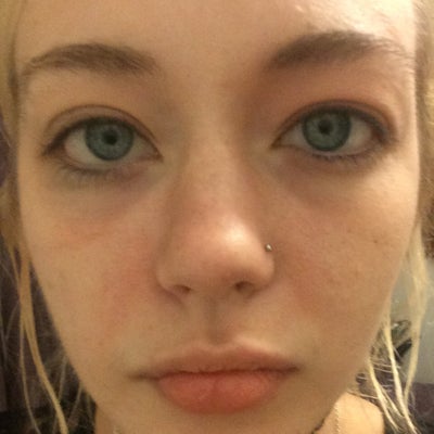 How to fix my asymmetrical eyes non-invasively? (Photo) Doctor Answers ...