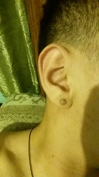 What is this lump that appears on my pierced ear? (Photo) Doctor ...