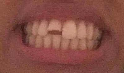 Front tooth broken in half due to trauma. What are my options? Will I ...