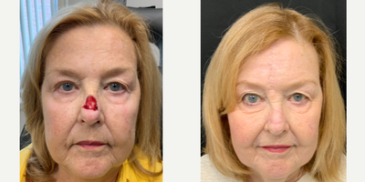 Mohs Surgery Before & After Pictures - RealSelf