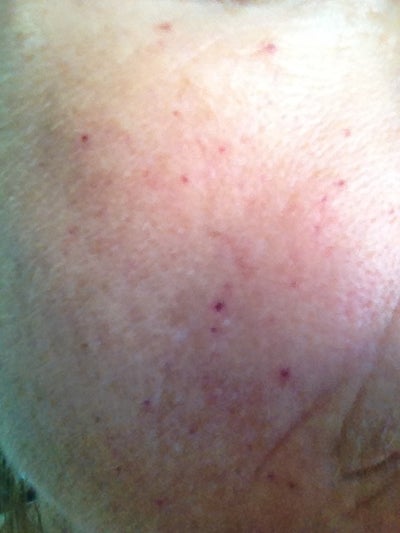 Sublative RF I have what looks like pores filled with blood in several ...